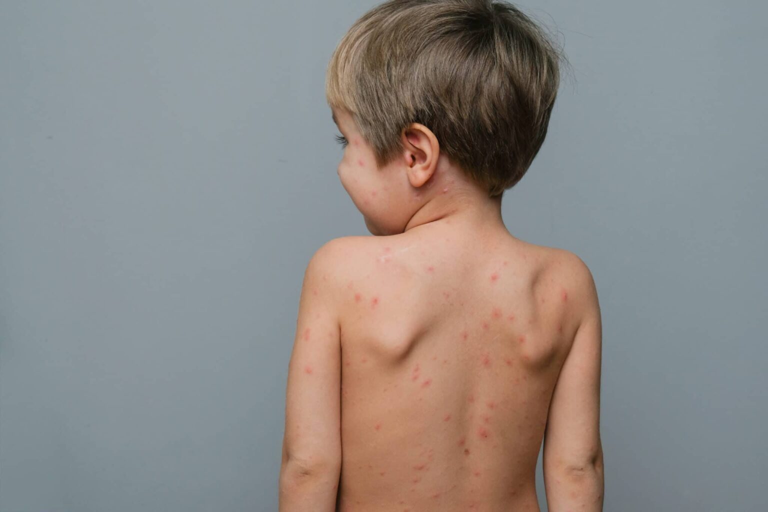 Die Windpocken (Varizellen): Symptome und Behandlung